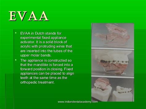 Combined Fixed Functional Class Ii Treatment