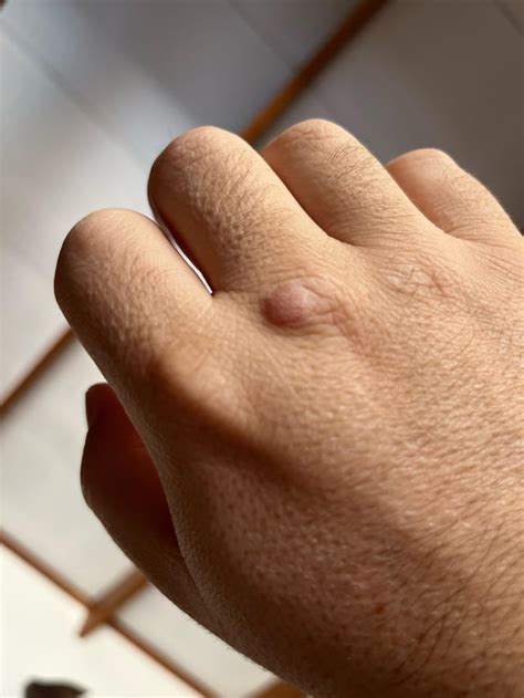Bump On Knuckle Rdermatologyquestions