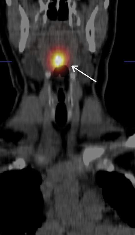 A Rare Case Of Lingual Thyroid In A Man Applied Radiology