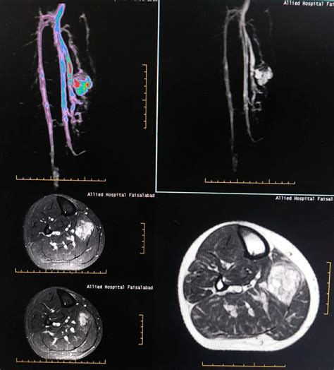 Non Contrast Mr Angiogram For Lower Limbs With Suspected Avm Muhammad Waqas