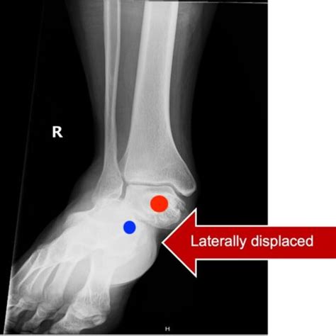A Case Report Of Lateral Subtalar Dislocation Emergency Medicine Assessment Management And