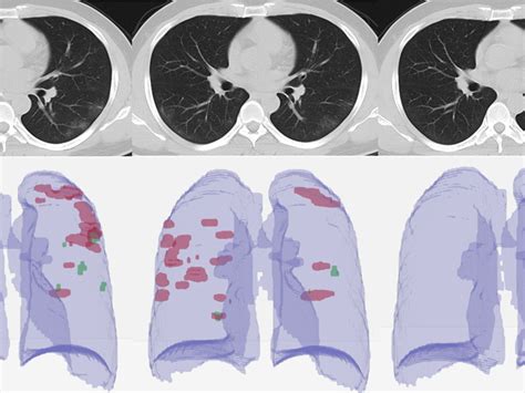 Hospitals Deploy AI Tools To Detect COVID On Chest Scans