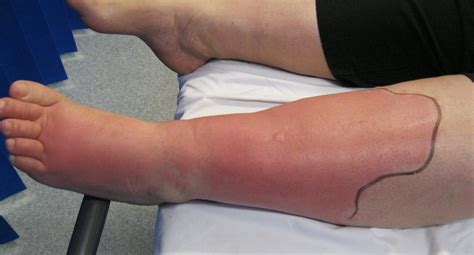 Erysipelas And Cellulitis Important Hot Topics Medizinonline