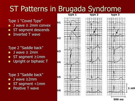 Brugada Syndromewhat To Know