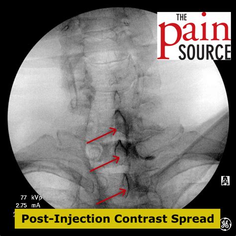 Cervical Epidural Injection With Contralateral Oblique View Technique And Tips The Pain Source