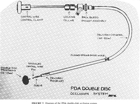 Figure From Nonsurgical Closure Of Patent Ductus Arteriosus Clinical Application Of The