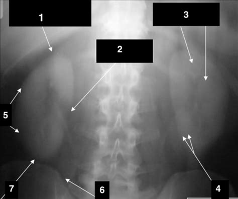 Ivp Tomography Anatomy Flashcards Quizlet