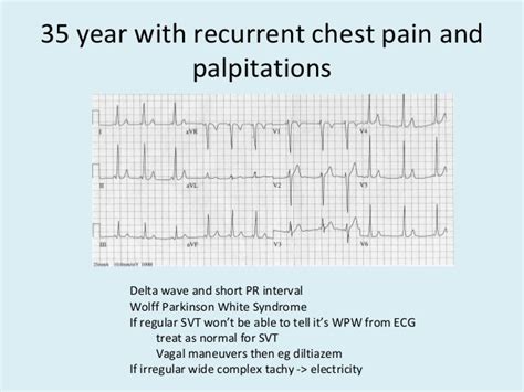 Icd 10 Atrial Flutter Merygod