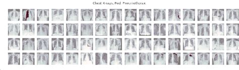 pneumothorax segmentation deep learning image segmentation to predict