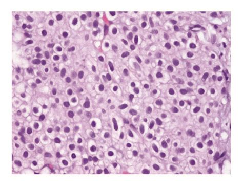 A Low Power View Of Multilobular Growth Pattern With Lobules