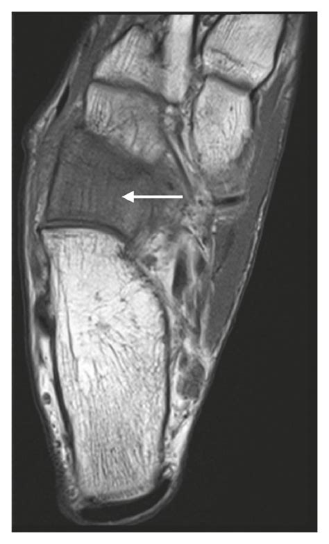 Cuboid Osteoid Osteoma In A 17 Year Old Presenting With A 2 Month Download Scientific Diagram