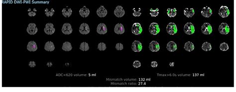 Perfusion Maps The Maps Show Unilateral Perfusion Deficits Which Download Scientific Diagram