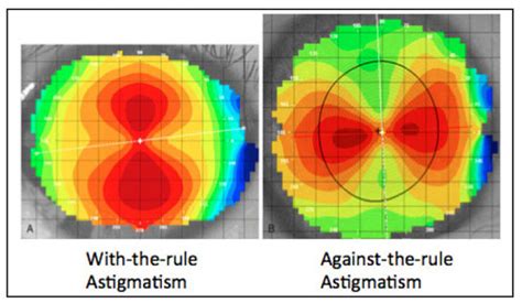 Older Age Affects Astigmatism In Higher Myopic Patients