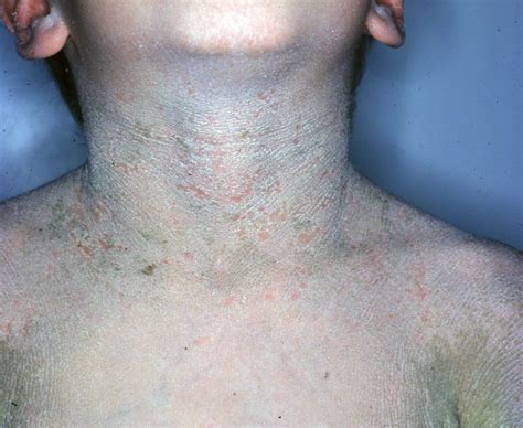 Epidermolytic Ichthyosis First Foundation For Ichthyosis And Related