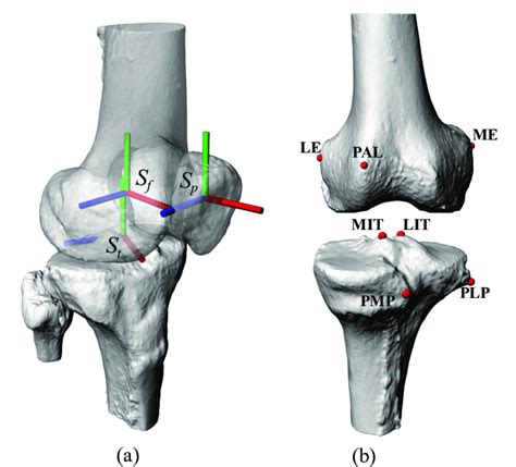 Tibial Epicondyle