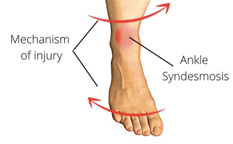 전하경비인대 염좌 High Ankle Sprain Syndesmotic Sprain 네이버 블로그