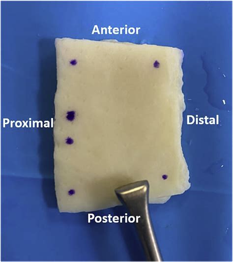 The Prepared Dermal Matrix Allograft Is Marked For Placement Of Sutures Download Scientific