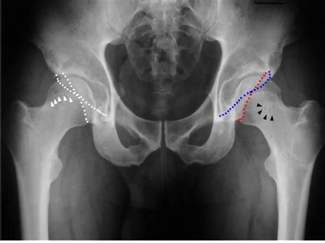 Impacto Femoroacetabular — Dr David Gusmão Ortopedista Do Quadril E