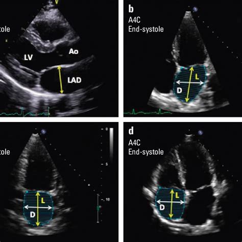 A Measurement Of The Left Atrial Diameter From The Parasternal Download Scientific Diagram