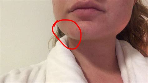 Acne Cyst Chin Acne Cyst Chin
