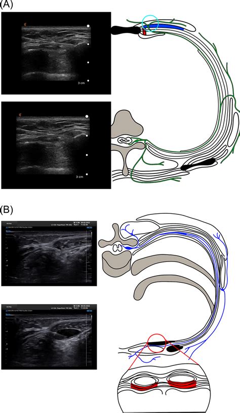 Sonoanatomy Of Pectoralis‐intercostal‐rectus Sheath Pirs Block A Download Scientific