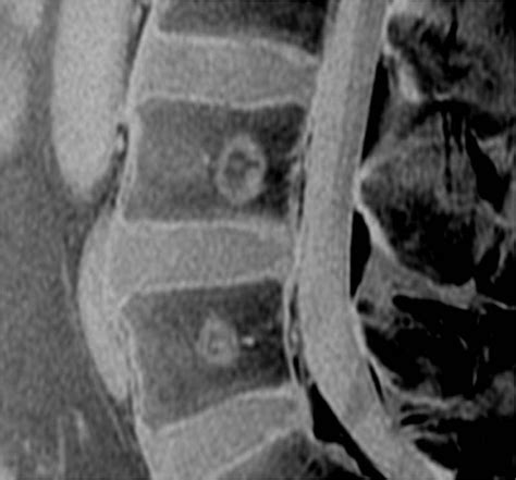 Ablation Of The Basivertebral Nerve For Treatment Of Back Pain A Clinical Study The Spine Journal