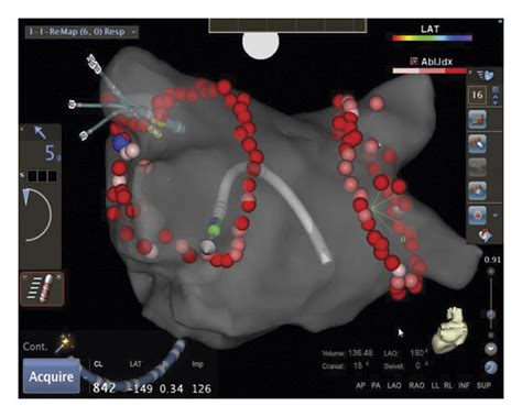 Radiofrequency Catheter Ablation Of Paroxysmal Atrial Fibrillation