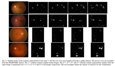 Mvit Research Lab Three Stages Hard Exudates Segmentation In Retinal Images Worapan