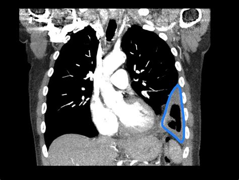 Case Report Of An Empyema Identified On Lung Ultrasound Jetem