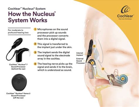 Cochlear Implant Pre Op And Post Op Mcguires Hearing 51 Off