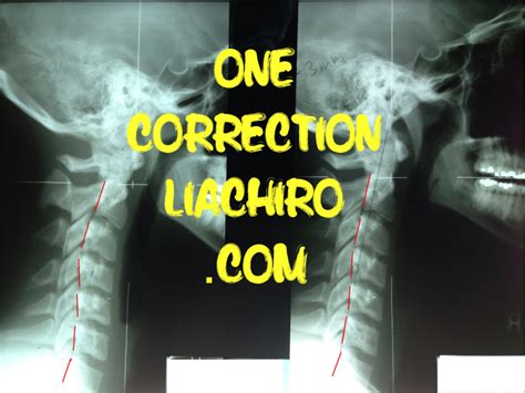 I Have A Reverse Cervical Curve Is This A Problem Can You Fix It
