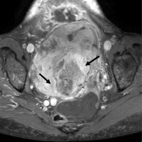 Axial Fat Suppressed Contrast Enhanced T1 Weighted Images Showing