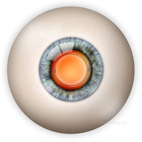 Cataract And Iol Surgery Stock Image Downloads