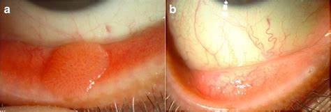 Conjunctival Papilloma Symptoms Sgtm