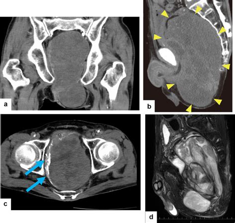 Surgical Removal Of Giant Pelvic Liposarcoma After Preoperative