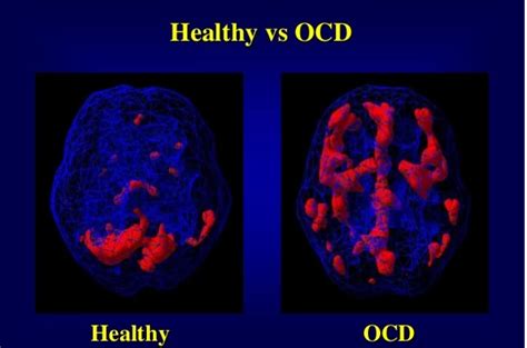 Obsessive Compulsive Disorder Ocd GenÇomÜ