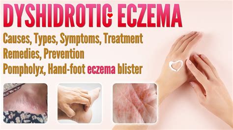 Dyshidrotic Eczema Symptoms Causes Treatment Ntunz