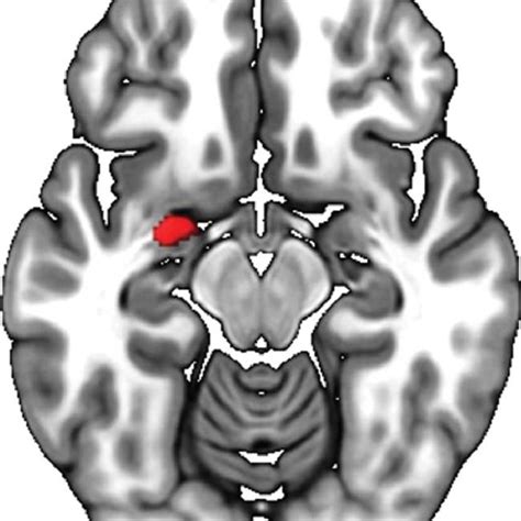 Voxel Based Morphometry In Compulsive Sexual Behaviors Greater Left Download Scientific