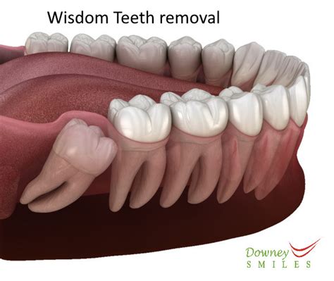 Wisdom Teeth Removal Wisdom Teeth Removal Dorset And Hampshire The