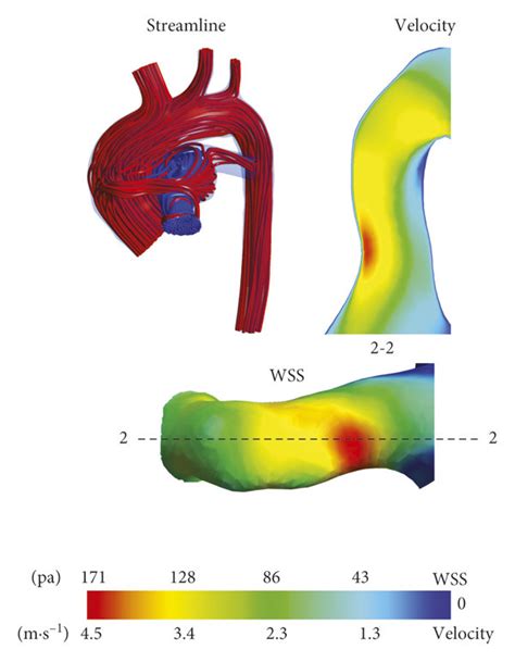 Streamline Velocity Contour And Wall Shear Stress Wss Plots At Cs Download Scientific