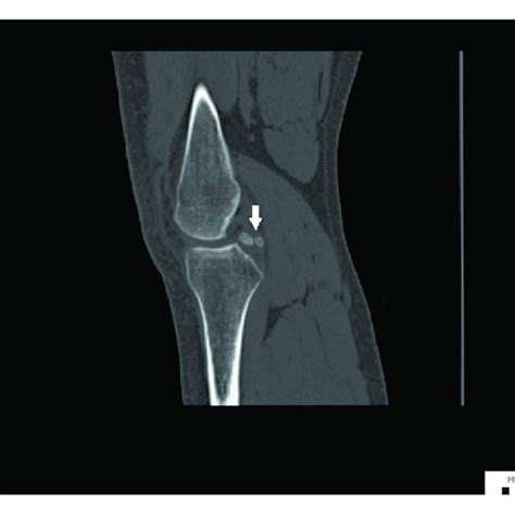 Pdf Double Meniscal Ossicle The First Description Ct And Mri