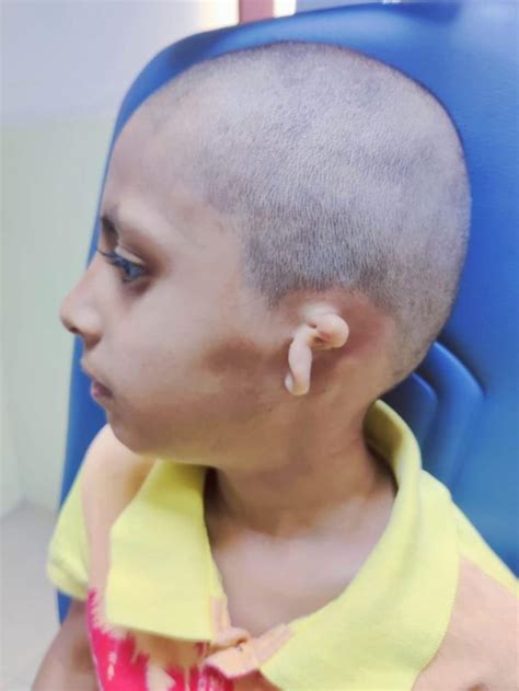 Command Hospital Pune Achieves Milestone With First Piezoelectric Bone Conduction Implants In Afms