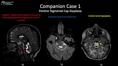 2 Year Old Male With Global Development Delay American Society Of