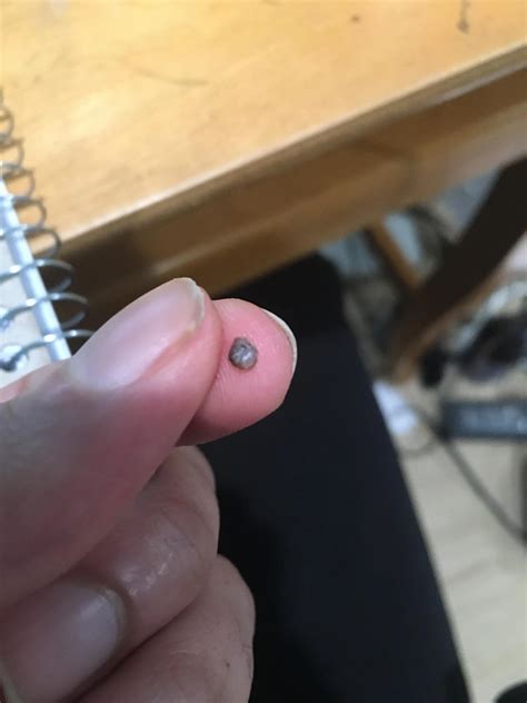 I Was Popping A Pimple On My Chest And Pushed Out This Thing What Is
