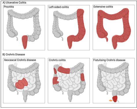 Malattia Infiammatoria Cronica Intestinale Ibd Quanto Sappiamo
