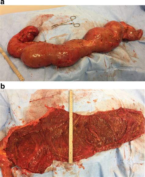 Surgical Specimen Demonstrates Marked Dilatation Of The Entire Duodenum Download Scientific