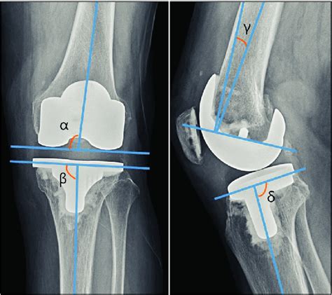 Radiographs Showing The Measurement Of Prosthesis Alignment Angles