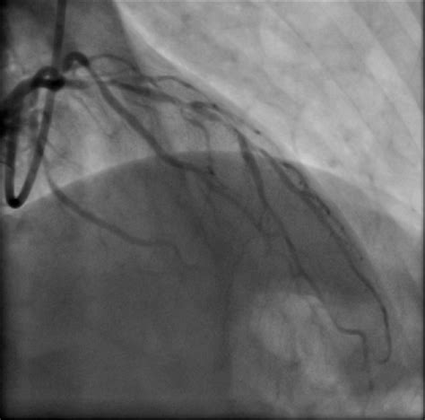 Figure 1 From Comparison Of Syntax Score And Syntax Score Ii To Predict