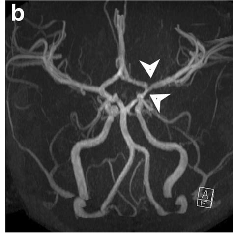 Pre And Postoperative Ct Suggesting The Intraventricular Arachnoid Cyst Download Scientific