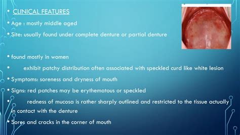 1 Denture Stomatitis Pptxftyftyytfytftfty Ppt